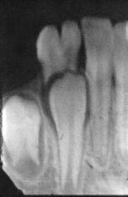 gemination - Kids Smiles Pediatric Dentistry